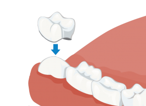 Dental crowns | Dentist Doncaster
